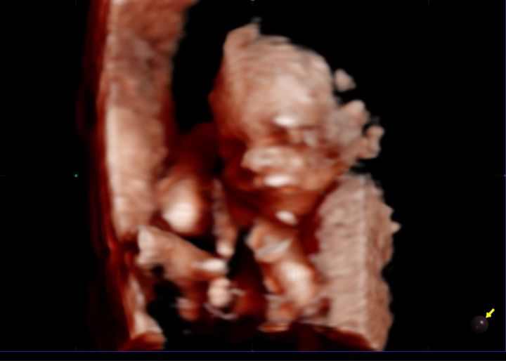 Ecografía de la semana 23: desarrollo del feto y cambios en la madre